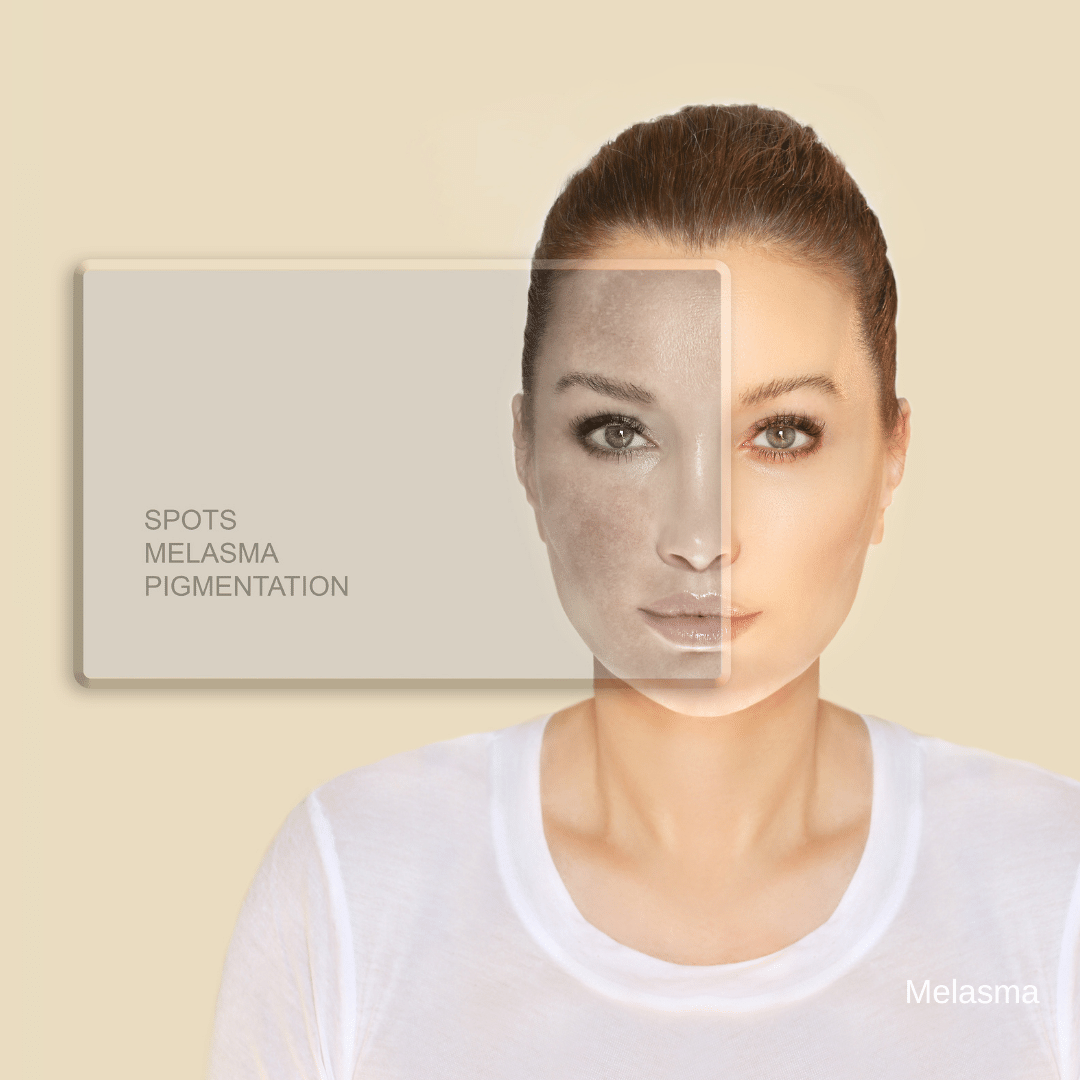 MELASMA – THE UNSOCIAL BUTTERFLY – Tatva Skin Clinic – Dermatology Clinic